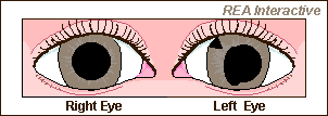 Richmond Eye Associates, Relative Afferent Pupillary Defect